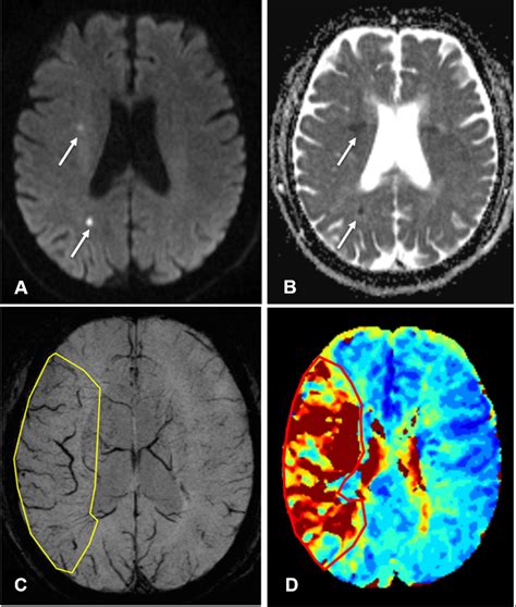 Quantitation Of Penumbra Volumes In Acute Ischemic Stroke Using Susceptibility Weighted Imaging