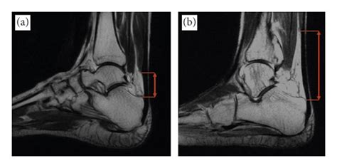 Free Achilles Tendon Length Differences On Sagittal T1 Weighted Mr