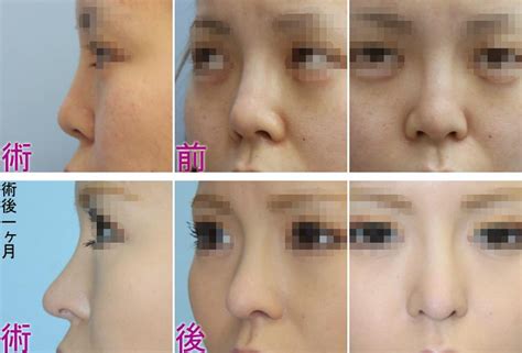 鼻中隔延長は横顔を劇的に変える ヤスミクリニック美容整形情報案内 美容外科手術を受ける人のために