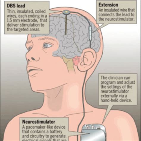 3 Epilepsy Prediction Implant 52 Download Scientific Diagram
