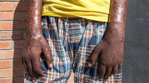 More Leprosy Cases Are Popping Up In Florida Heres What To Know