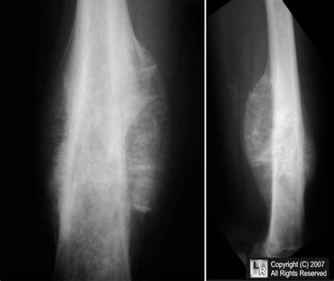Patologia de Órgãos e Sistemas Sarcoma de Ewing