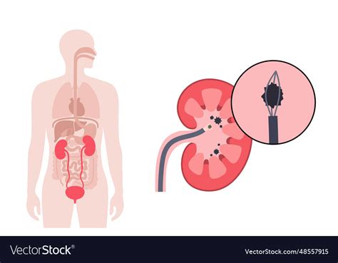 Ureteroscopy Medical Poster Royalty Free Vector Image