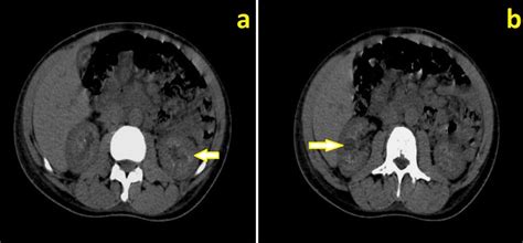 Noncontrast Computed Tomography Of Abdomen Showing Bilateral Medullary