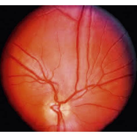Cluster View With Glaucoma Image Objects Download Scientific Diagram