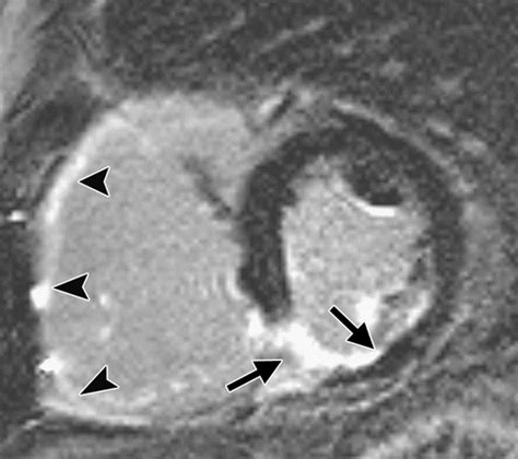 Mr Imaging Of Myocardial Infarction Radiographics