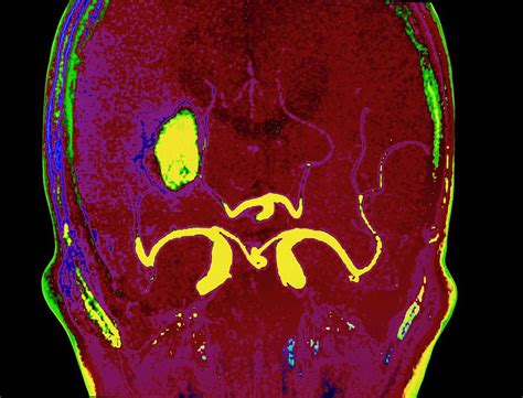 Coloured Mri Scan Of A Cerebral Infarction Photograph By Simon Fraser