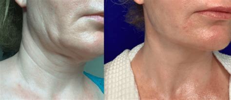 Laser Muscle Toning Woodlands Texas Dermanature Inc