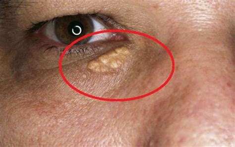 How To Treat Xanthelasma Or Cholesterol Deposits Around The Eyes In 2020 Bumps Under Eyes