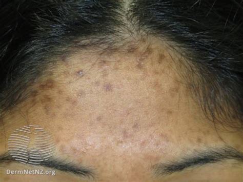Hyperpigmentation Skin Triggers Effects And Treatments Hyperpigmentation Skin Triggers Effects And Treatments