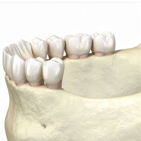Ridge Augmentation Glenbrook Oral And Maxillofacial Surgery
