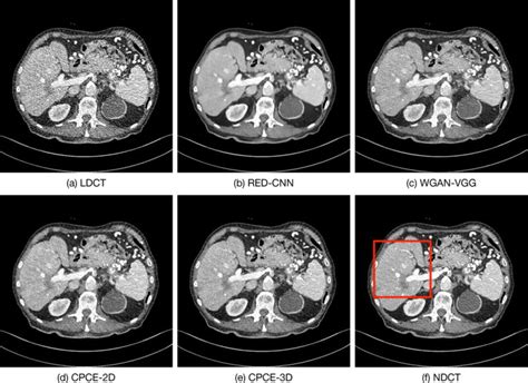 3d Convolutional Encoder Decoder Network For Low Dose Ct Via Transfer
