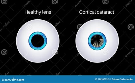 Cataract Eye Disease Vector Illustration 326960732