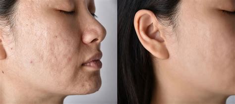 Know How Long Does It Take For Acne Scars To Fade The Pink Foundry