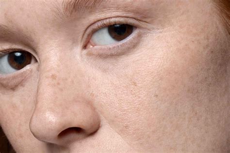 What Are Age Spots Causes Types Melasma Lentigo And Solutions For