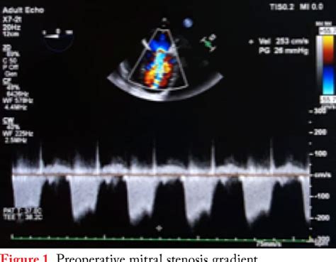 Figure 1 From Supravalvular Mitral Ring In A Patient With Turner