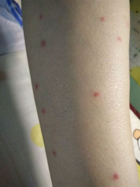腿上长红疙瘩很痒图片大腿红疙瘩瘙痒图片 伤感说说吧