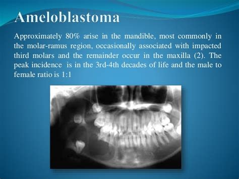 Ameloblastoma