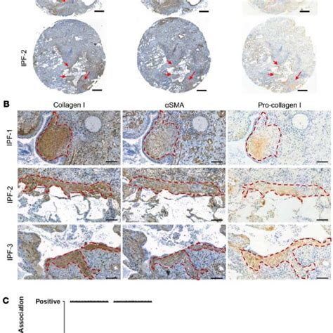 Distribution Of Fibronectin And Collagen Vi In The Fibroblastic Focus