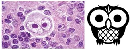 A Birds Eye View Of Hodgkin Lymphoma Oncology Buddies