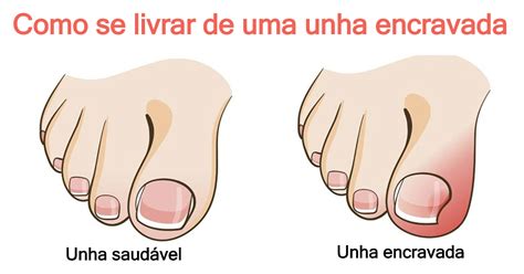 Como Se Livrar De Uma Unha Encravada Sem Cirurgia Quatro Dicas Maisvibes