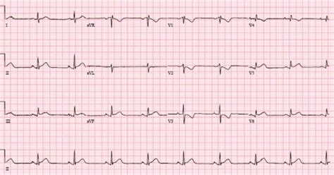 Cardiac Syncope ECG Interpretation ECG Cases EM Cases
