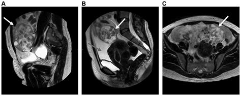 T2 Weighted Pelvic Magnetic Resonance Imaging A And B Sagittal And