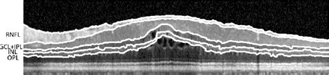 Figure From Retinal Layers Segmentation Using Fully Convolutional