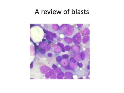 Acute Promyelocytic Leukemia