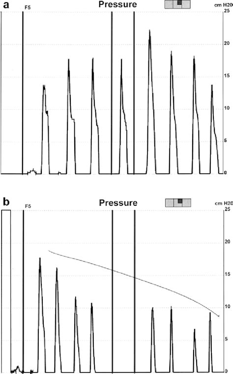 A B Vaginal Pressure Profiles During Pelvic Floor Muscle Contraction Download Scientific