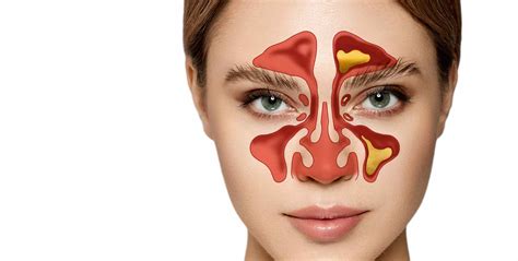 Sinusitis Treatment The Ultimate Guide Healthy Türkiye