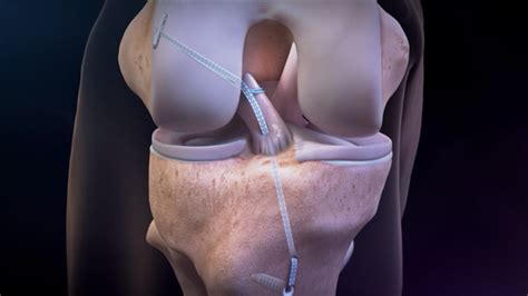 Rupturas Do Ligamento Cruzado Anterior Lca Animação Do Reparo Do Lca