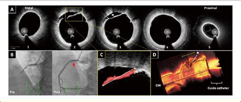 Representative Case Of Intimal Flap Detected By Optical Frequency Download Scientific Diagram