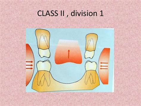Angles Classification Of Malocclusion