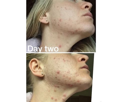 Doxycycline 50mg Once Daily Prescription Acne Medications