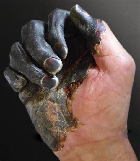 ما هو الطاعون الدملي وما الفرق بينه وبين كورونا الجديد جريدة الوطن