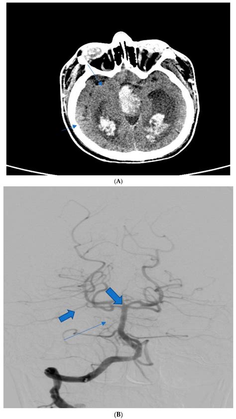 Interpeduncular Cistern Hemorrhage