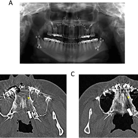 Radiographic Examination After Surgery A A Panoramic X Ray Taken 1