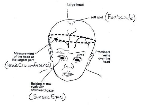 Hydrocephalus In Pediatrics Hubpages