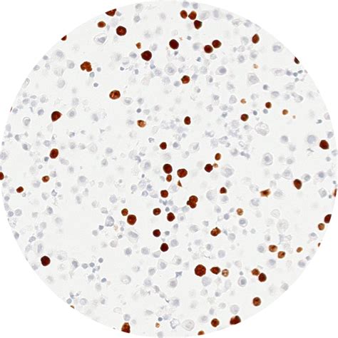Cell Culture Microarrays Cancer Controls