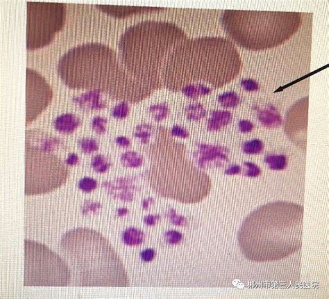 “血小板”骗局的反思 红细胞 张女士 仪器