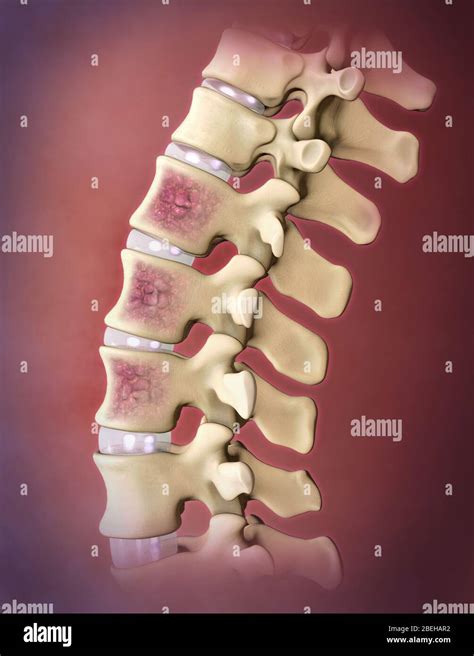 Multiple Myeloma Skeleton Fotos Und Bildmaterial In Hoher Auflösung