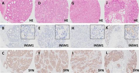 Insm1 Expression Groups In Conventional Crcs With Diffuse Expression Of