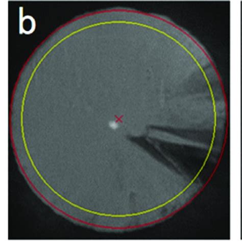 Kanazawa Medical University Cataract Classification And Grading System