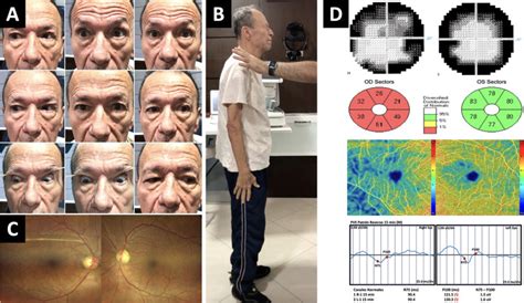 Parálisis Supranuclear Progresiva Síntomas Y Soluciones Clave
