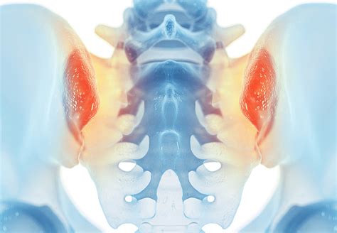 Sacroiliac