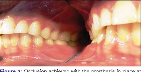 Figure 3 From Maxillary Palatal Ramp Prosthesis A Prosthodontic