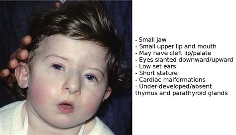 Digeorge Syndrome Md Searchlight