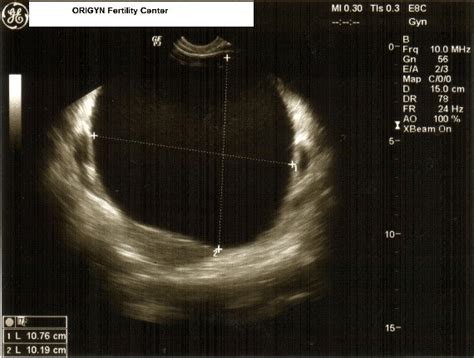 Ultrasound Image Of Anechoic Cyst No Septa Were Observed Thin Walls