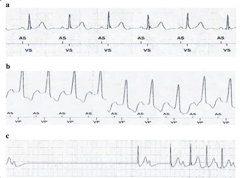 A Pacemaker Recording Of Patient In Sinus Rhythm Prior To Ogds Download Scientific Diagram